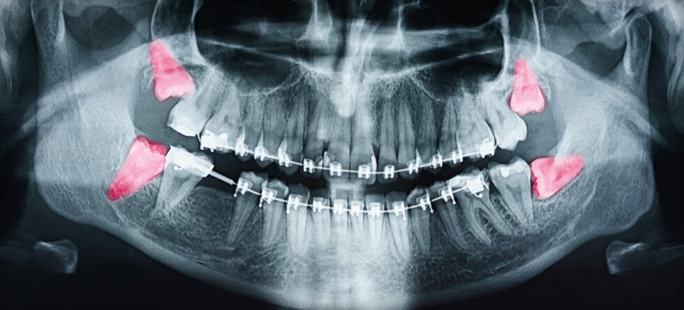Wisdom Teeth Extractions - Pewaukee Dental